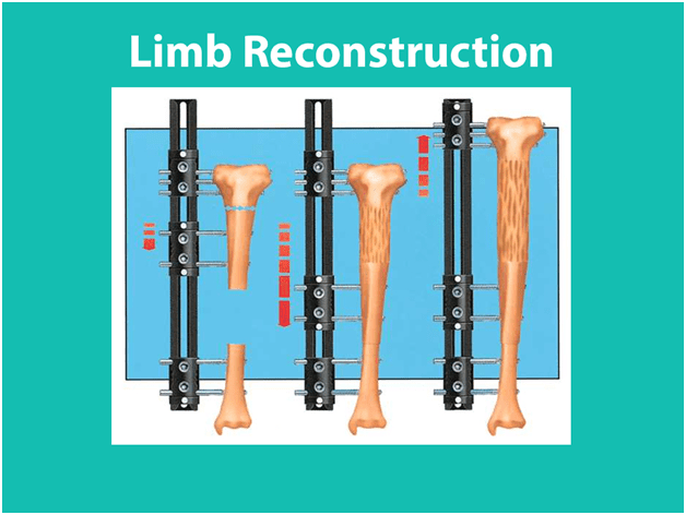 Limb Reconstruction Treatment in Gurgaon | Young Bones Clinic