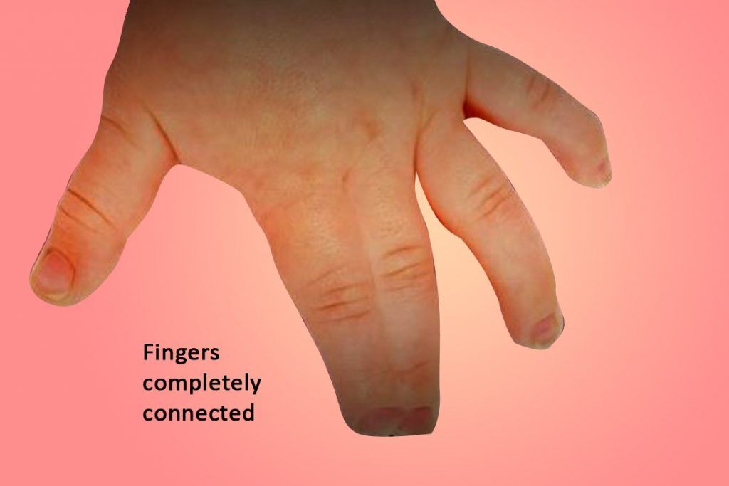 Pediatric Hand Disorders- All you need to know - Young Bones Clinic